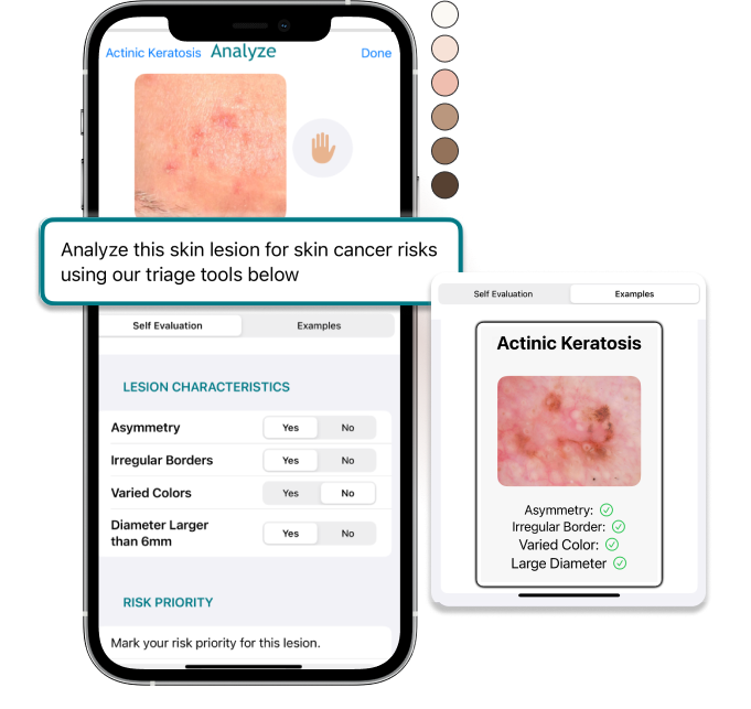 Democratizing Early Skin Cancer Detection